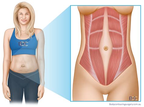 Everything You Need To Know About Diastasis Recti