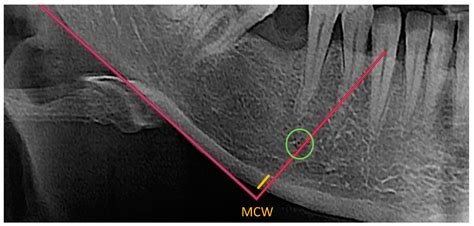 Osteoporosis Screening Using Dental Panoramic Radiographs And Age At
