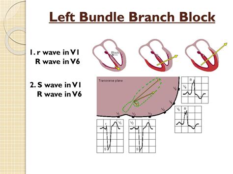 Ppt Bundle Branch Block Powerpoint Presentation Free Download Id
