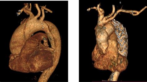 One Stage Total Repair Of An Acute Type A Aortic Dissection With Total Download Scientific