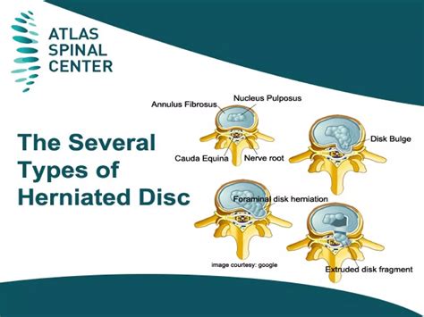 What Is Herniated Disc Ppt