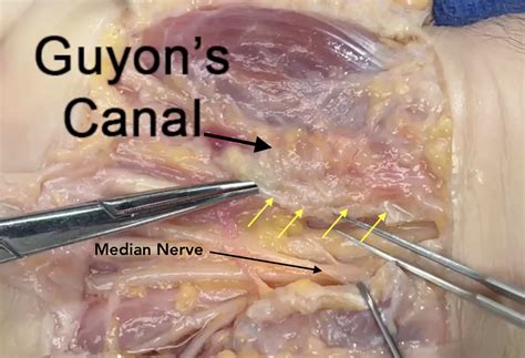 Ulnar Nerve In Guyons Canal Anatomic Structures At Risk