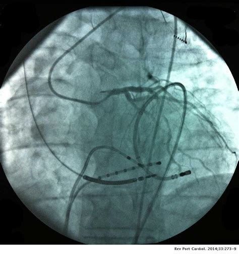 Percutaneous Epicardial Ablation In Ventricular Arrhythmias Revista Portuguesa De Cardiologia