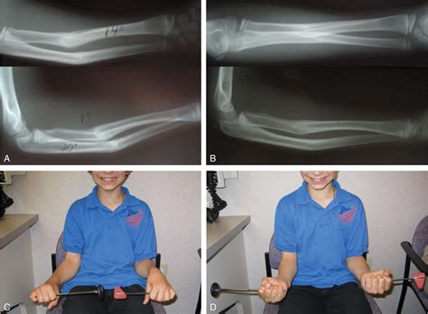 Forearm Fractures Clinical Tree