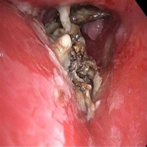 Image Captured During Bronchoscopy Visualizing What Appeared As Download Scientific Diagram