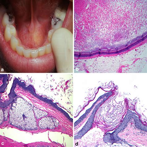 Pyostomatitis Vegetans A Irregular Linear “snail” Tracts Along The Download Scientific Diagram