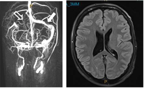 Full Article Papilledema And Pseudopapilledema In Alagille Syndrome A