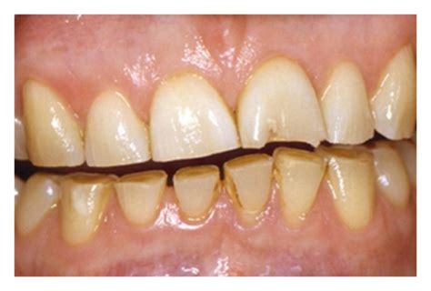 Photographs Of A Patient With Attritional Wear Of The Maxillary And