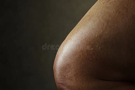 Close Up Of Fat Swollen Leg Showing Inflammation And Edema Stock Illustration Illustration Of