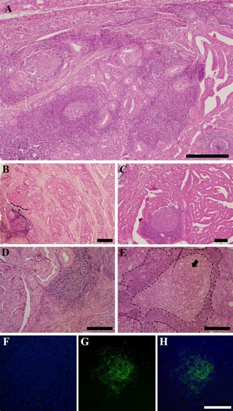 Tertiary Lymphoid Structures In Thyroid Cancer Archives Of