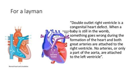 Dual Outlet Right Ventricle Double Outlet Right Ventriculum Dhtxb