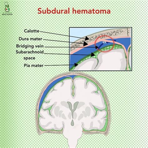 Subdural Hematoma Bridging Veins