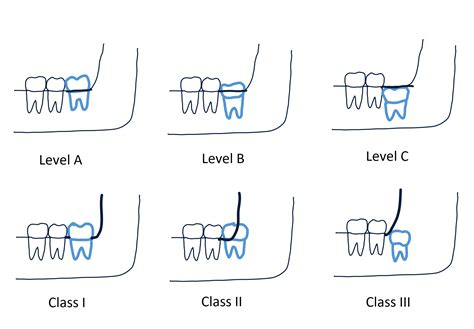 Pericoronitis Treatment And Management Point Of Care