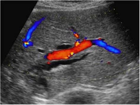 Abdomen And Retroperitoneum 12 Gallbladder And Bile Ducts Case 12