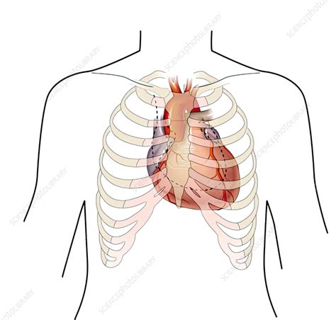 Heart Anatomy With Ribs Cardiomegaly Illustration Stock Image