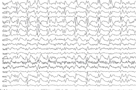 Figure 1 From Periodic Eeg Patterns Importance Of Their Recognition