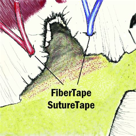 Arthroscopic View Right Shoulder Subacromial Space From Anterior Download Scientific Diagram