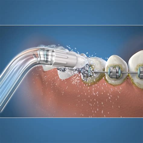Waterpik Orthodontic Water Flosser Tip Ultramed