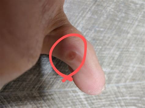 엄지발가락과 2번째발가락 사이에 물집같은거 지식in