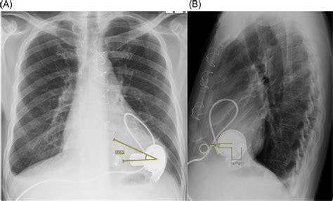 Patient With Heartware Lvad Somewhat Inferiorly Angulated Relative To