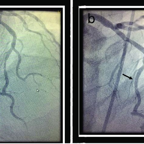 Dynamic Compression Of The Tunneled Segment Of The Mid Left Anterior Download Scientific