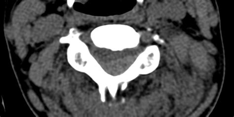 Spinal Epidural Hematoma By Alexander Baxter Radnotes