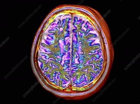 Multiple Sclerosis Rotating Axial Mri Scan Stock Video Clip K007