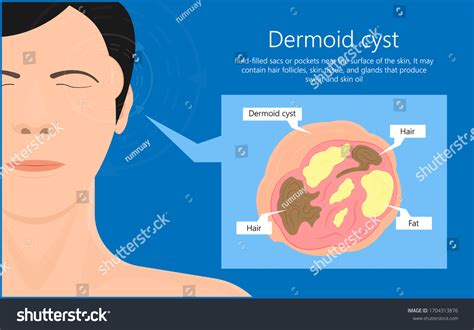 Dermoid Cyst Ovary Eye