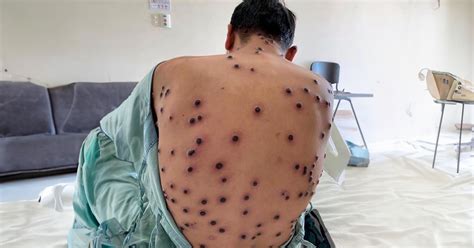 Viruela Del Mono Qué Es Causas Cómo Prevenirla Formas De