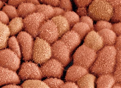 Rectal Polyp Surface Sem Stock Image M240 0660 Science Photo Library