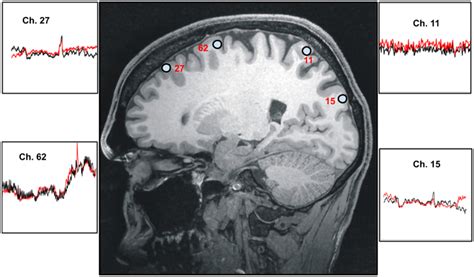 Fnirs Spatial Reconstructions Patient 10 To Illustrate Our Networks