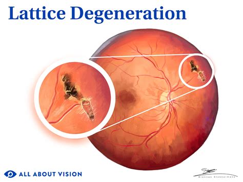 Lattice Degeneration Risks Treatment And Symptoms