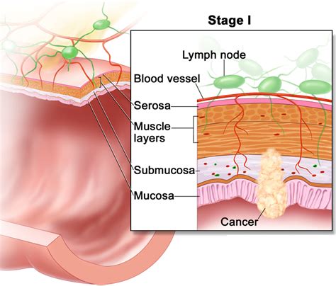 Colon Cancer Causes Signs Symptoms Stages Screening And Treatment