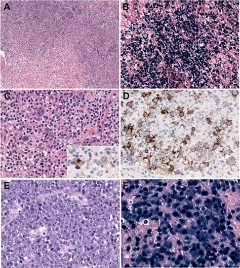 Ebv Positive Diffuses Large B Cell Lymphoma Nos A D Polymorphic Download Scientific Diagram