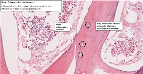 Bone Osteomyelitis Nus Pathweb Nus Pathweb