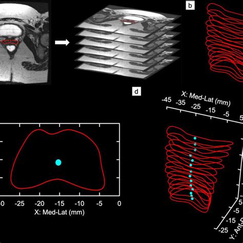 Calculation Of The Central Vaginal Axis A 2d Segmentation Dotted