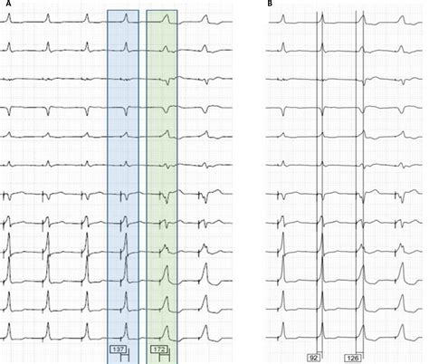 His Bundle Pacing And Left Bundle Branch Area Pacing Feasibility And