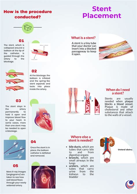 Stent Placement Process And Post Operative Care