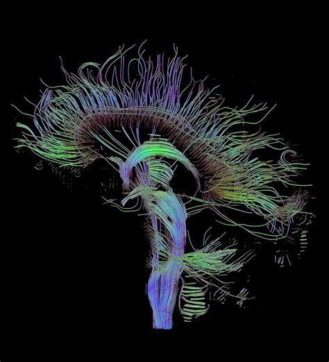 Diffusion Tensor Imaging Dti Definition