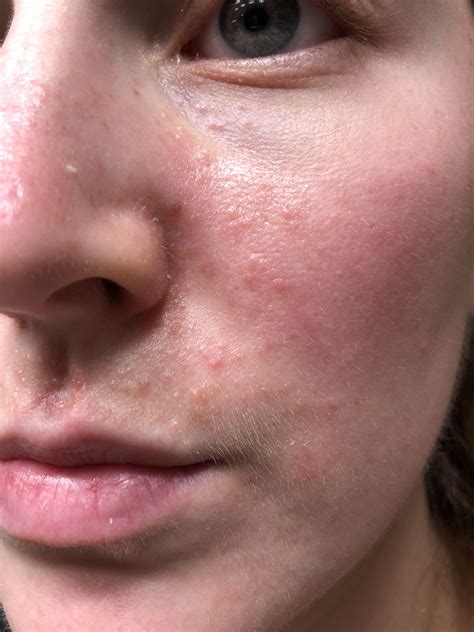 Best Doxycycline Images On Pholder Skincare Addiction Acne And Rosacea