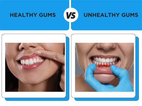 How Do Healthy Gums Appear — Kwc Dental