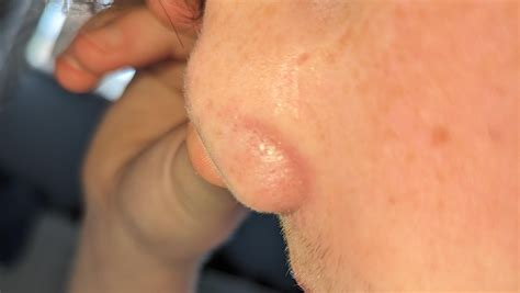 Redness Around Nose Rskincareaddicts