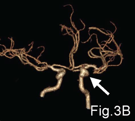A C Show The Mra Cta And 3d Dsa Respectively Of The Left Internal Download Scientific