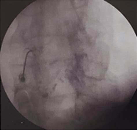 Complications Of Lumbar Facet And Medial Branch Blocks And Ablations Anesthesia Key