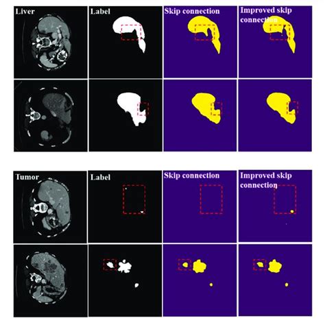 Segmentation Results Of General Skip Connection And Improved Skip