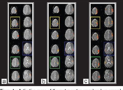 Figure 1 From Ultrafast Bold Fmri Using Single Shot Spin Echo Echo Planar Imaging Semantic Scholar
