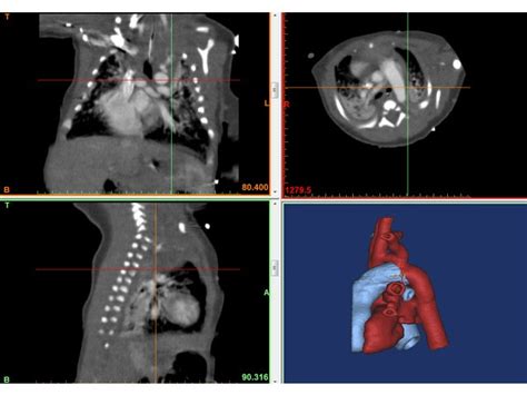 Neonatal Pda With Coarctation Of Aorta And Hypoplastic Arch 3d Life