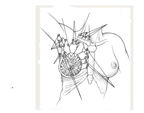 Breast Lymph Node Quiz