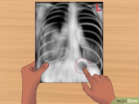 How To Read A Chest X Ray With Pictures WikiHow