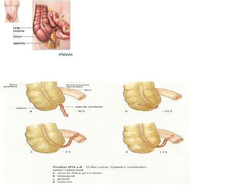 Materi Askep Makalahku Apendisitis